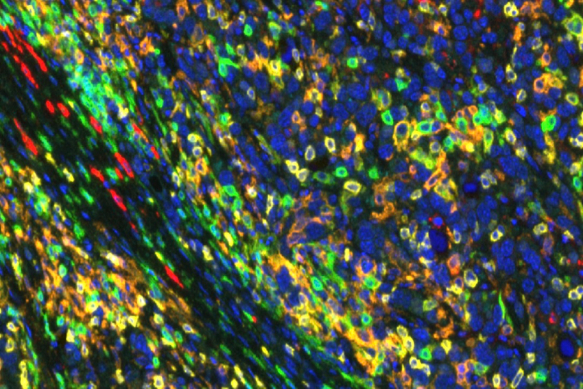 Roswell Park Team Proposes Strategy for Making Pancreatic Tumors ...