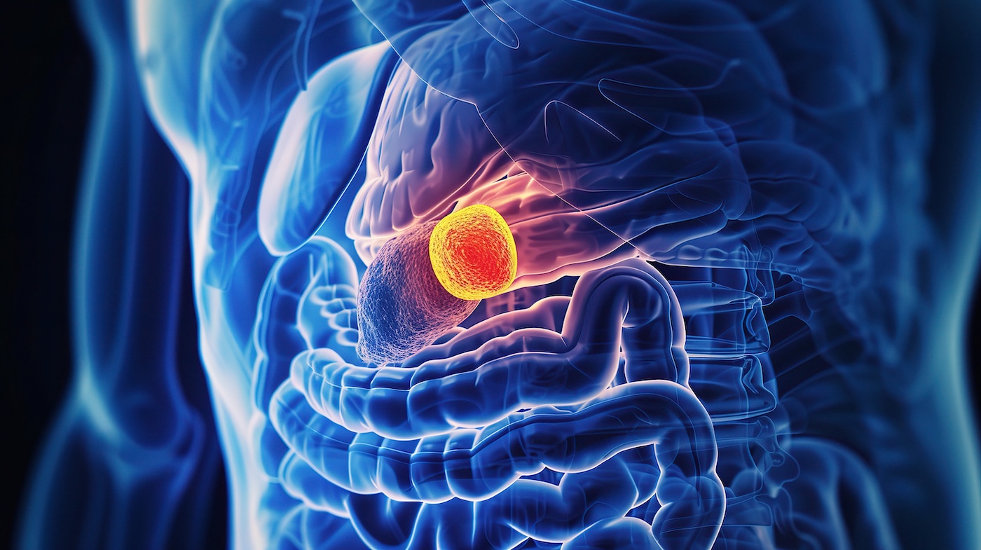 How can pancreatic cancer be diagnosed early? | Roswell Park ...