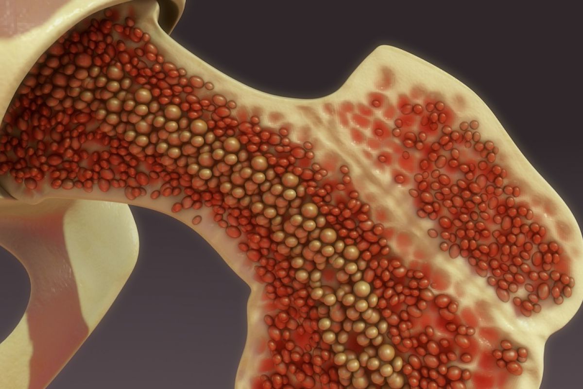 What Are Myelodysplastic Syndromes Mds Roswell Park Comprehensive Cancer Center