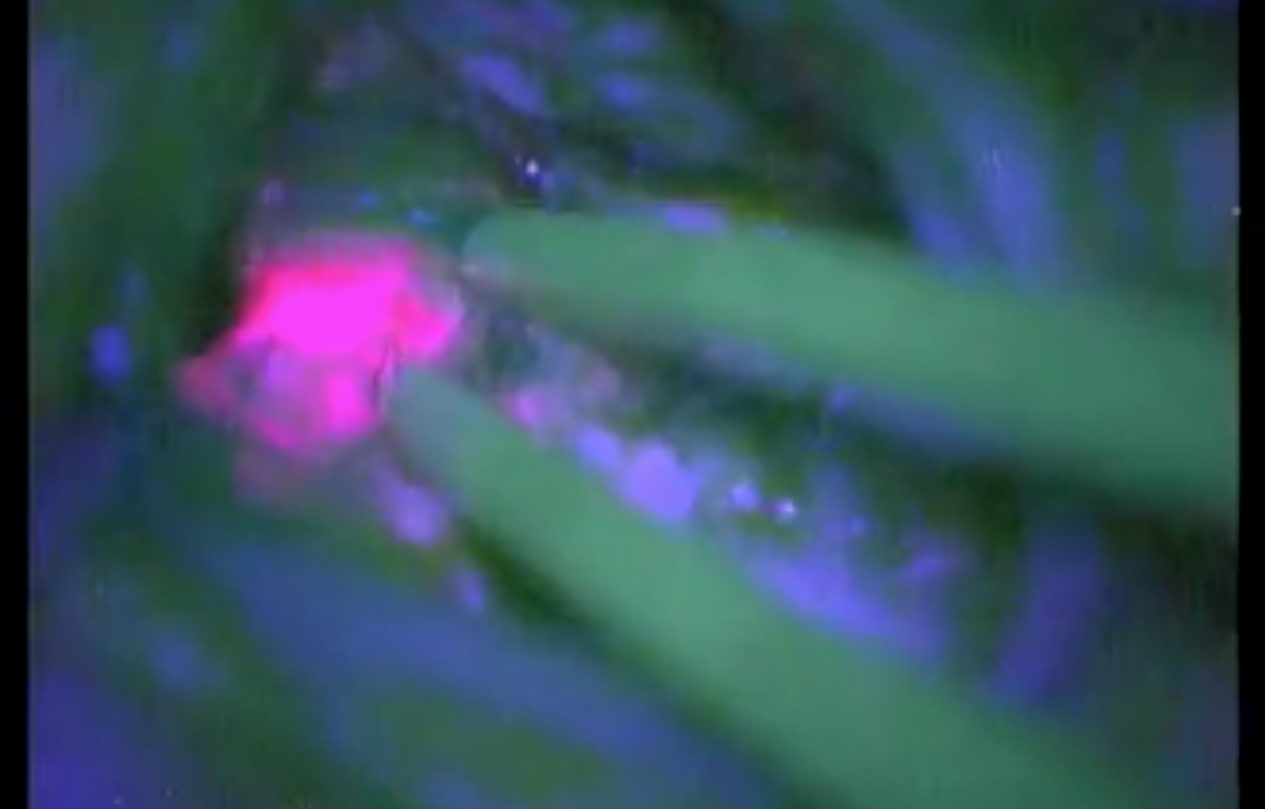 New Technique Helps Roswell Park Neurosurgeons Remove Brain Tumors More ...