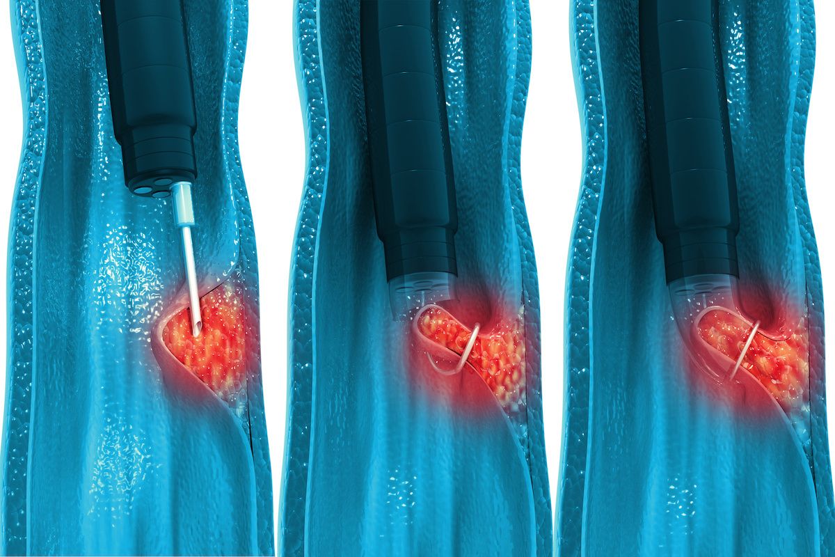 What are complex polyps? | Roswell Park Comprehensive Cancer Center ...