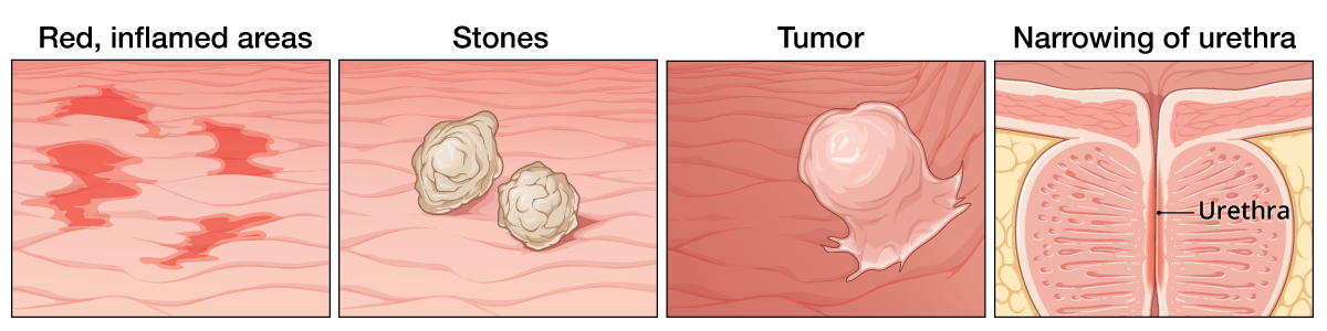 How is Bladder Cancer Diagnosed? | Roswell Park Comprehensive Cancer ...