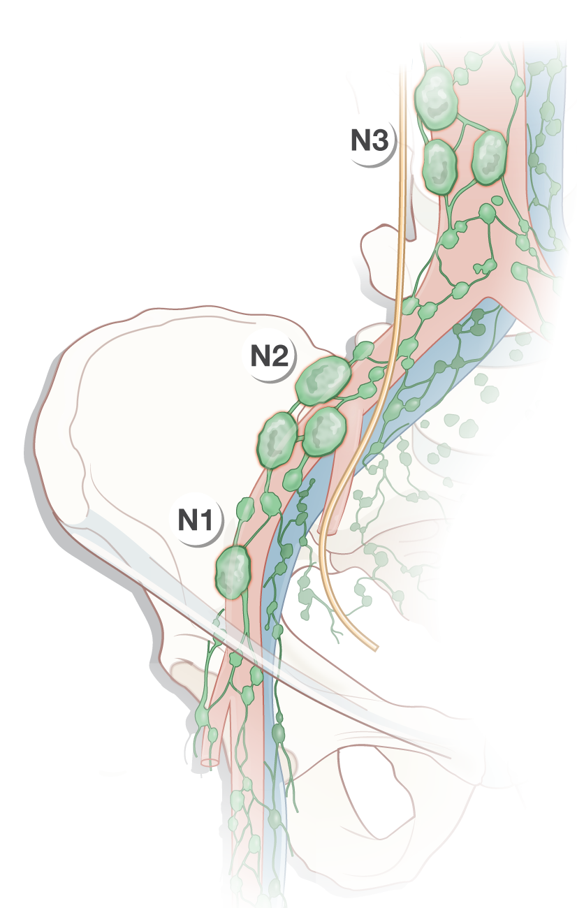 Bladder Cancer Staging | Roswell Park Comprehensive Cancer Center ...