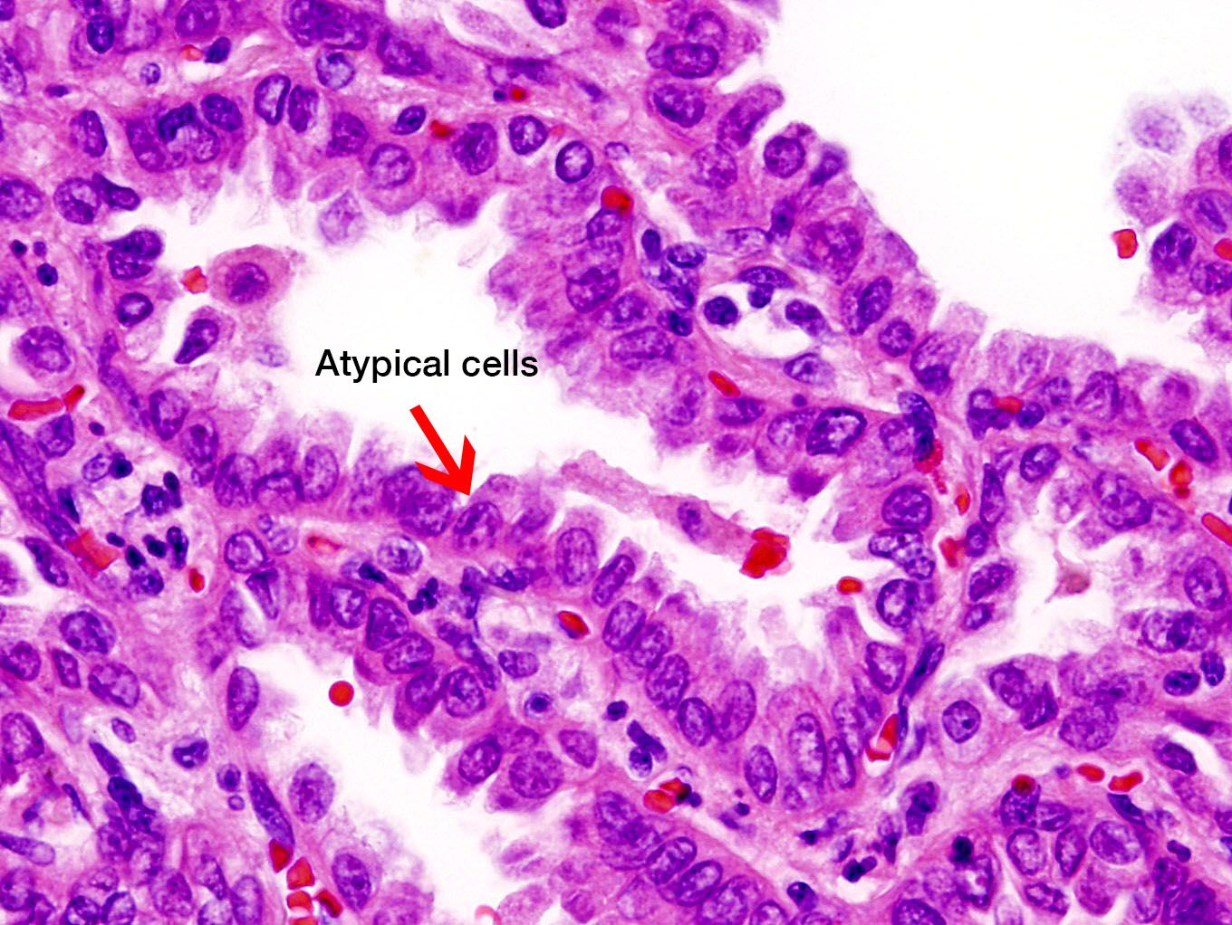 Pathology Report 101 | Roswell Park Comprehensive Cancer Center - Buffalo, NY