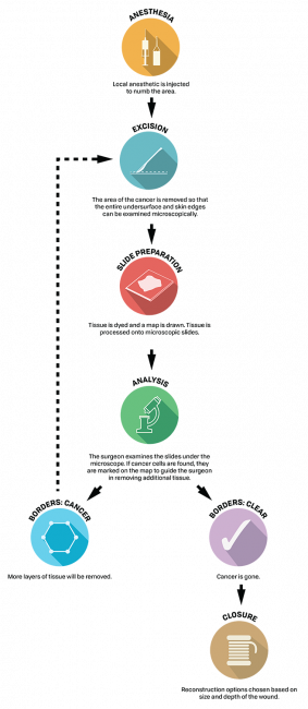 How to Prepare for Mohs Surgery | Roswell Park Comprehensive Cancer Center