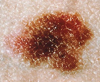 Skin Cancer Symptoms | Roswell Park Comprehensive Cancer Center ...