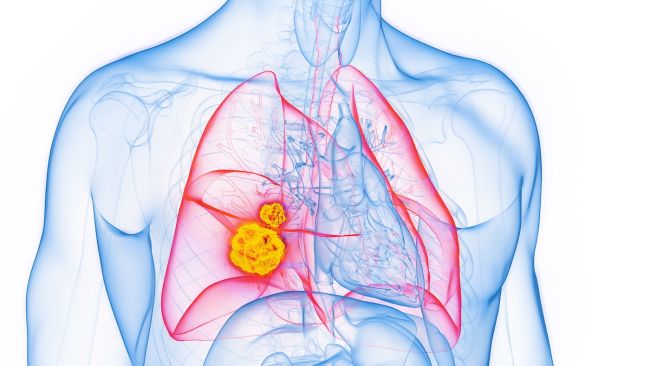 When To Worry About Lung Nodules Roswell Park Comprehensive Cancer Center Buffalo Ny
