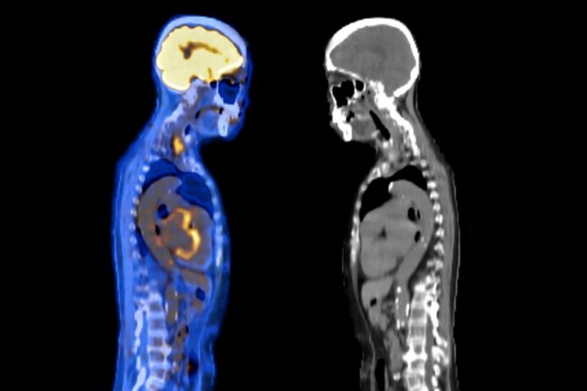 What's a PET Scan? | Roswell Park Comprehensive Cancer Center - Buffalo, NY