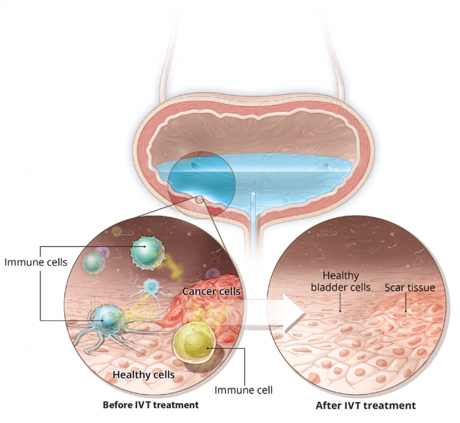 What Is Intravesical Therapy Roswell Park Comprehensive Cancer